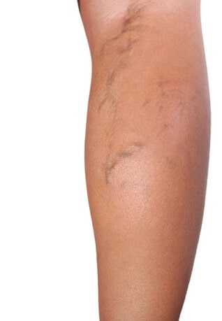 Eliminar varices en Madrid | Centro Médico El Pilar