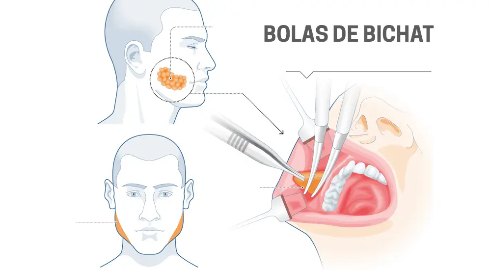 Bolas de bichat y Bichectomia - Centro Médico El Pilar Bolas de bichat y Bichectomia - Centro Médico El Pilar