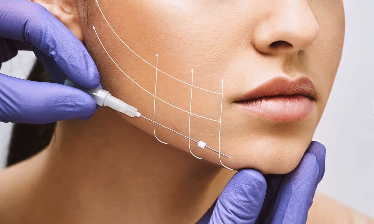 ¿Como son los Hilos tensores? Tipos y tratamiento - Centro Médico El Pilar